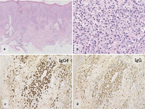 Patient 1 A This Case Showed A Nodular Dermatitis Pattern Hande B Patient 1 A This Case Showed A Nodular Dermatitis Pattern Hande B