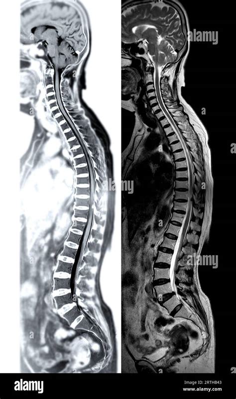 Mri Whole Spine Screening For Diagnosis Spinal Cord Compression Stock