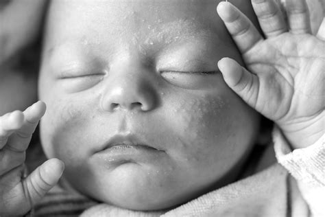 Rer Lacné Du Nourrisson Causes Et Traitement Rer