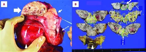 A Macroscopic Findings Of The Primary Inferior Vena Cava Download Scientific Diagram