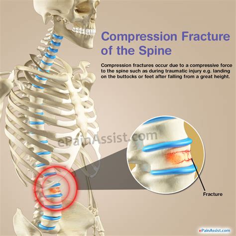 Compression Fracture Of The Spine Understand The Causessymptoms
