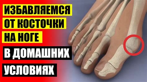 🤢 НА НОГЕ ВЫСКОЧИЛА ШИШКА 🎯 РАСТЕТ КОСТЬ НА НОГЕ ВОЗЛЕ БОЛЬШОГО ПАЛЬЦА Youtube