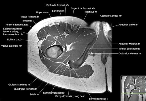 Mri Anatomy Of Hip Joint Free Mri Axial Hip Anatomy 46 Off