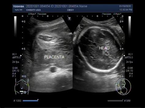 Ultrasound Video Showing Oligohydromnios Almost Anhydramnios With Pregnancy Of 30 Weeks