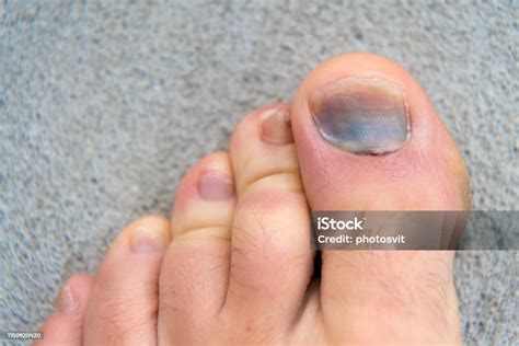 발가락 부상 타 박상 및 외상 치료 의료 개입 골절 불편 한 신발 손톱 곰 팡이 건강 한 발 손가락 혈 종 Desease 페디큐어 발병 치료 타 박상 및 골절 치료 발톱에