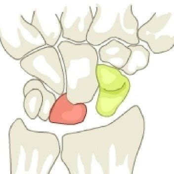 In Case Of Rotary Subluxation Of The Scaphoid Scapholunate Angle Download Scientific Diagram
