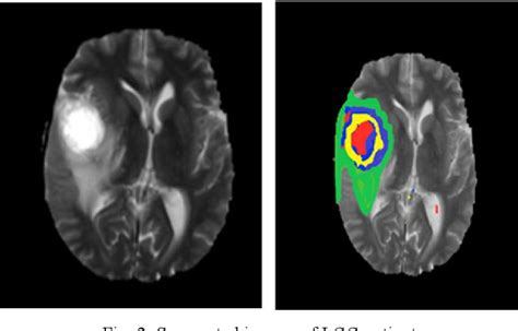 Figure 3 From An Accurate Brain Tumor Segmentation Using Deep Learning Semantic Scholar