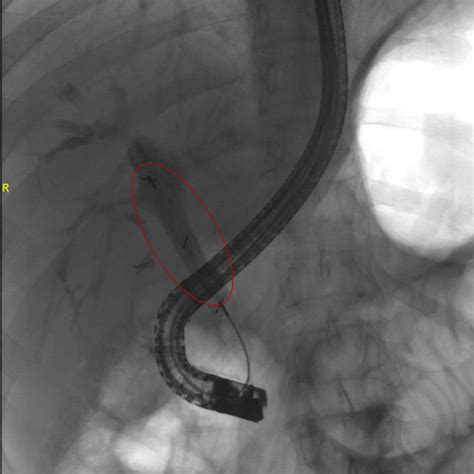 Pdf Removal Of Proximally Migrated Biliary Stents By Using Single Operator Cholangioscopy