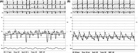 Ra And Pa Waveforms Following Placement Of Rp Impella Repeat Waveforms Download Scientific