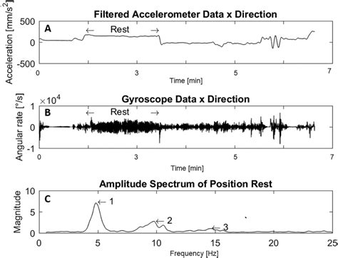 Tremor Analysis With Wearable Sensors Correlates With Outcome After Thalamic Deep Brain