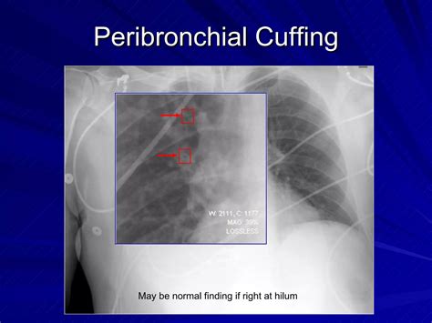Chest Radiology In Intensive Care Ppt