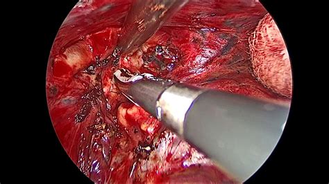 Uniportal Vats Anatomic Right Basal Segmentectomy S7 10 Youtube