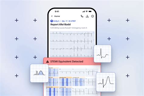 Stemi Ecg Criteria Key Insights Into Ischemic St Elevation Patterns