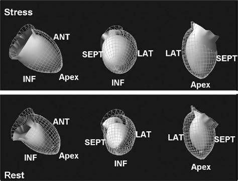 Figure 3 From Importance Of Gated Imaging In Both Phases Of Myocardial Perfusion Spect