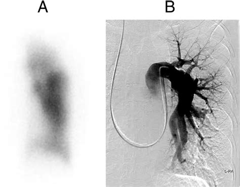 A Lung Perfusion Scintigraphy Demonstrated No Perfusion In The Right Download Scientific