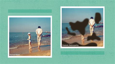 Diabetic Retinopathy Signs And Symptoms