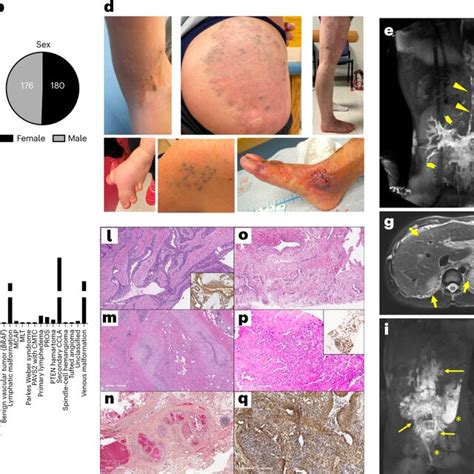 Molecular Yield And Findings Ac Molecular Yield By Diagnosis A