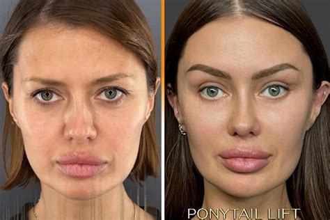 Без фильтров до и после пластики Американский хирург впервые показал настоящее лицо 44 летней