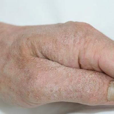 Mild Norwegian Scabies