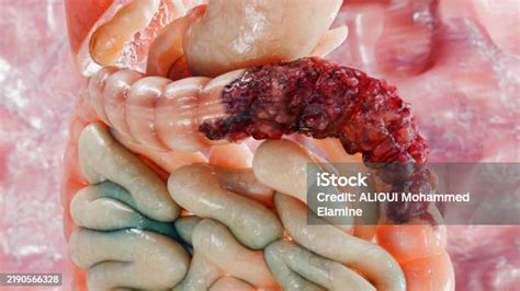 Foto De Colorectal Cancer Malignant Tumor In Intestine Endoscope Inside