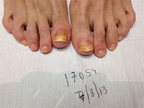 Toenail Fungus Before And After Photos Advanced Podiatry Of Manhasset Huntington Coram