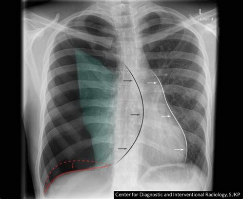 Left Pneumothorax X Ray
