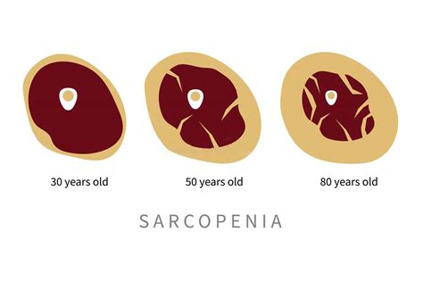 Longevitytechfund Blog Sarcopenia Age Related Muscle Loss