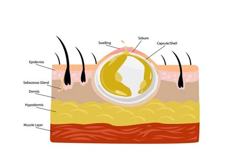Abscess Drainage Palmer General Surgeon Mat Su Surgical Associates