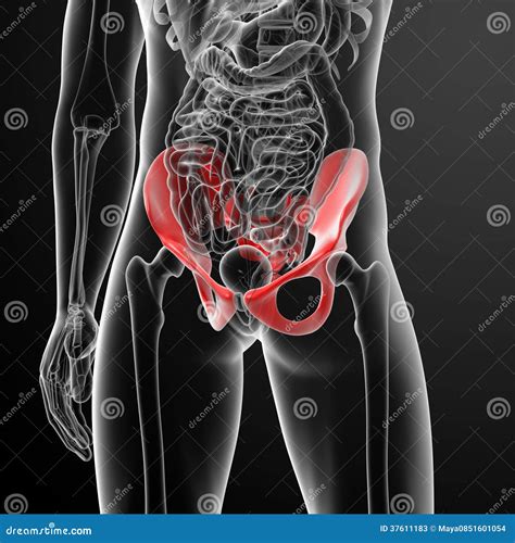 Pelvis Hip Fracture Hip Dislocation Vector Illustration
