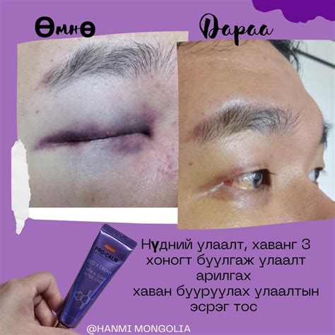 Мон хатан төв Улайлт хөхрөлт арилгах тос нь ирлээ Нүүрний мэс заслын дараах хөхрөлт