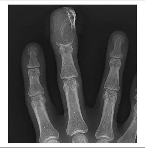 Figure 4 From A Case Of Metastatic Prostate Cancer To The Distal Phalanx Semantic Scholar