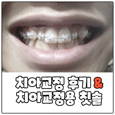 치아교정칫솔 위턱 아래턱 교정 진행과정 후기 네이버 블로그