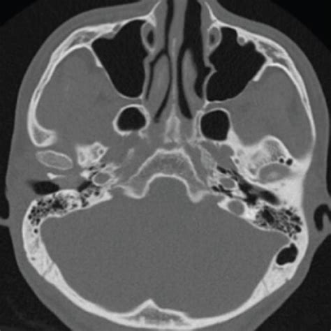 Excision Of External Auditory Canal Cholesteatoma In Patients With Eacc Download Scientific