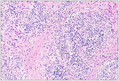 Ama Ed Hub On Linkedin Nodular Vulvar Lesions