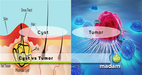 Difference Between A Cyst And A Tumor Epidermoid Cyst Cysts Tumor