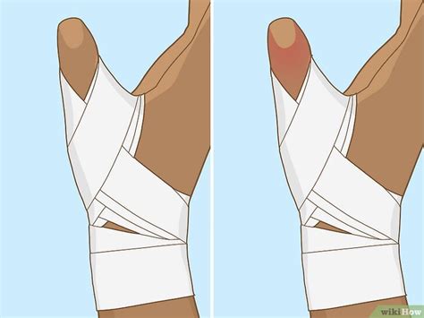 How To Wrap A Sprained Thumb Easy Step By Step Guide