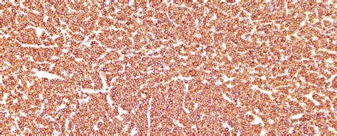 ‘capicua Gene Plays A Key Role In One Of The Most Common Types Of