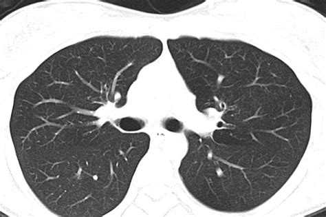 lung cancer screening low dose ct uf health jacksonville