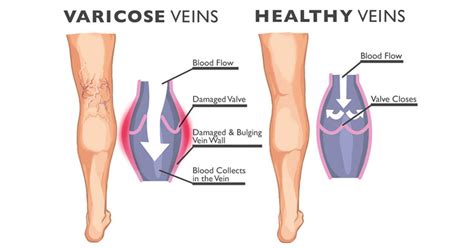 6 Proven Ways To Prevent Varicose Veins