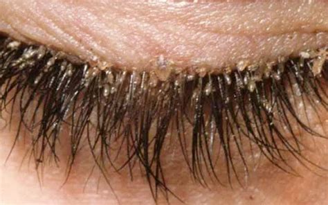 Understanding Demodex Blepharitis And Its Treatment Specialty Vision