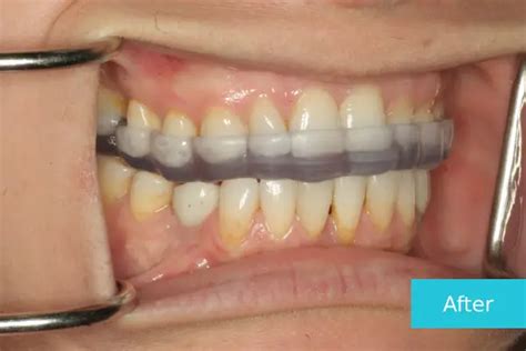 TMJ Treatment In London Trusted TMJ Dentists Specialists