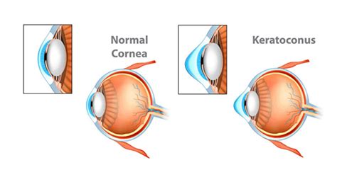 Cornea And Keratoconus Treatment In Pune Expert Eye Care At Dudhbhate Netralay