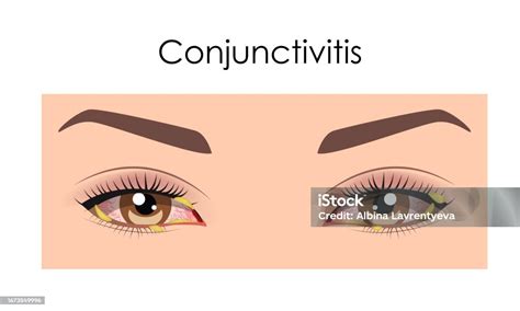 Conjunctivitis Eye Disease Medicine Flat Vector Illustration Stock