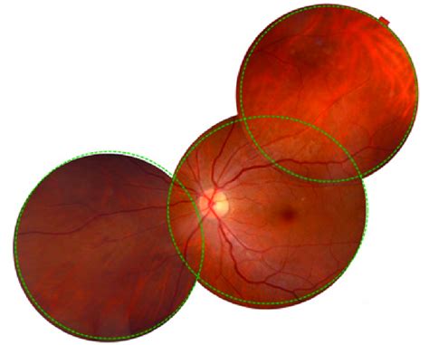 Collage Photograph Of The Three Field Non Mydriatic 45 Degree Download Scientific Diagram