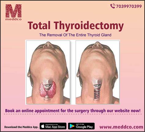 Thyroidectomy Frontiers Comparison Of Supraclavicular Oblique