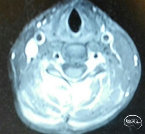 浙江省人民医院神经外科团队：脊髓毛细胞型星形细胞瘤（1例） 脑医汇