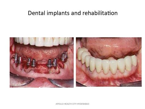 Jaw Bone Cancer Treatment In Kphb Expert Mandibulectomy