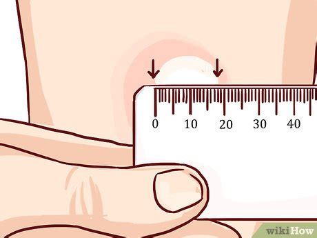How To Read A Tuberculosis Skin Test 9 Steps With Pictures