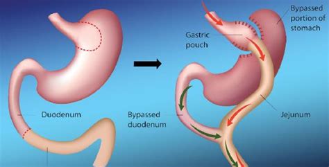 Laparoscopic Roux En Y Gastric Bypass Surgery Dr Dhruv Kundra