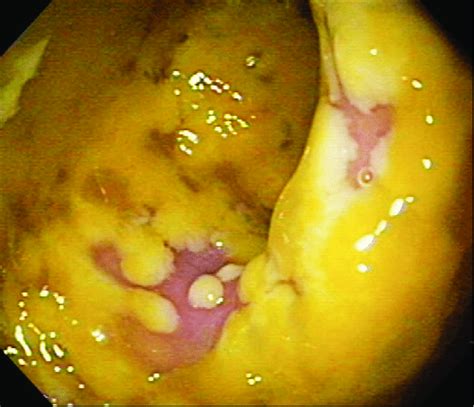 Pseudomembranous Colitis Appearance Of Pseudomembranes On Colonoscopy